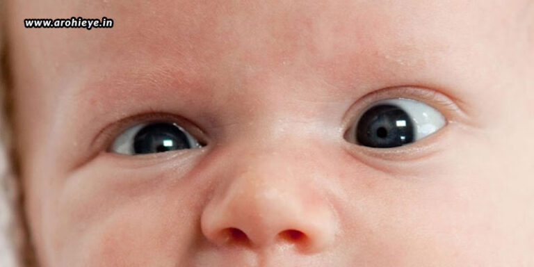 Squint In Children – Symptoms And Treatment - Arohi Eye Hospital