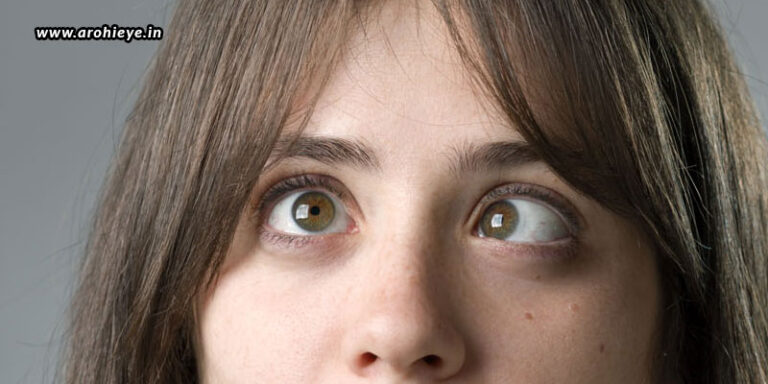 Squint In Adults – What And How? - Arohi Eye Hospital