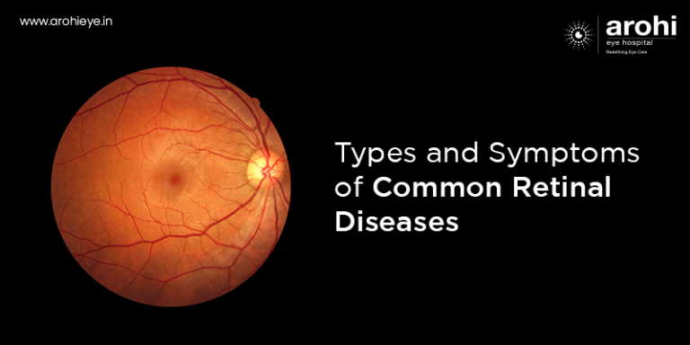 Retina Treatment : Types and Symptoms of Common Retinal Diseases