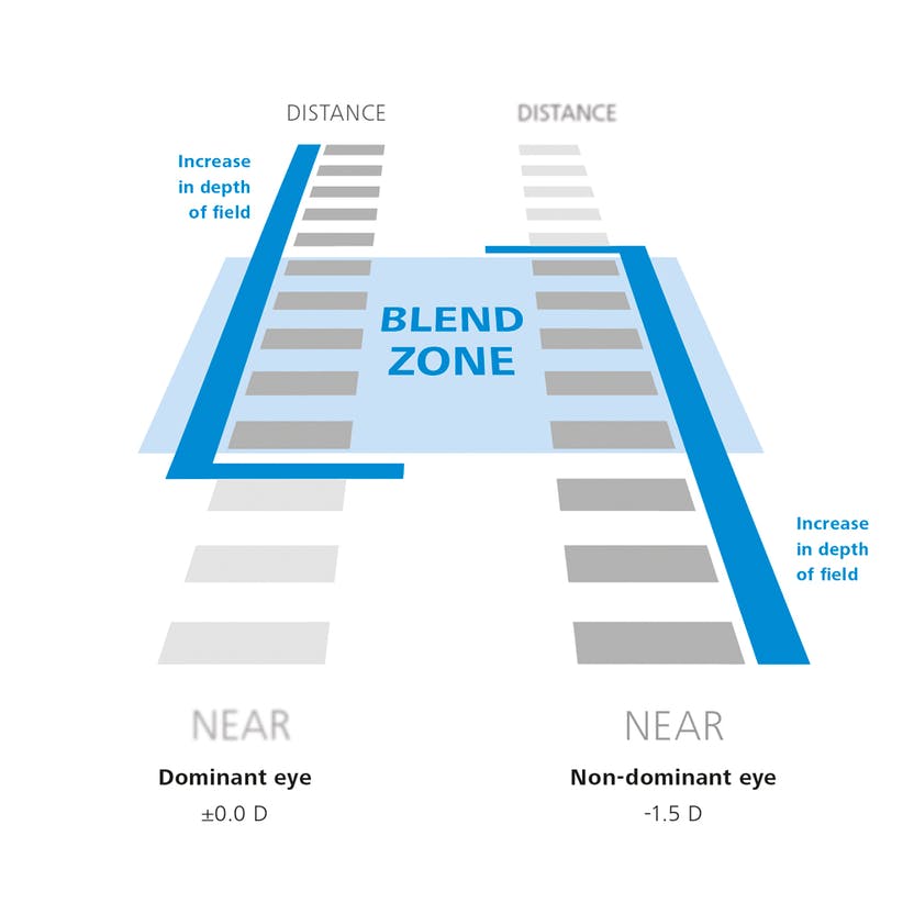 Blended vision LASIK surgery, blended vision cataract surgery