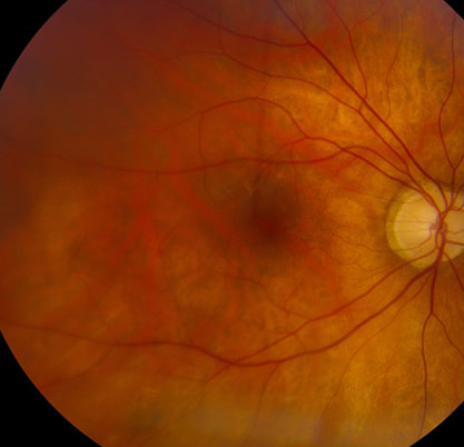 Best Retina Specialist in Mumbai | Retina Treatment in Mumbai